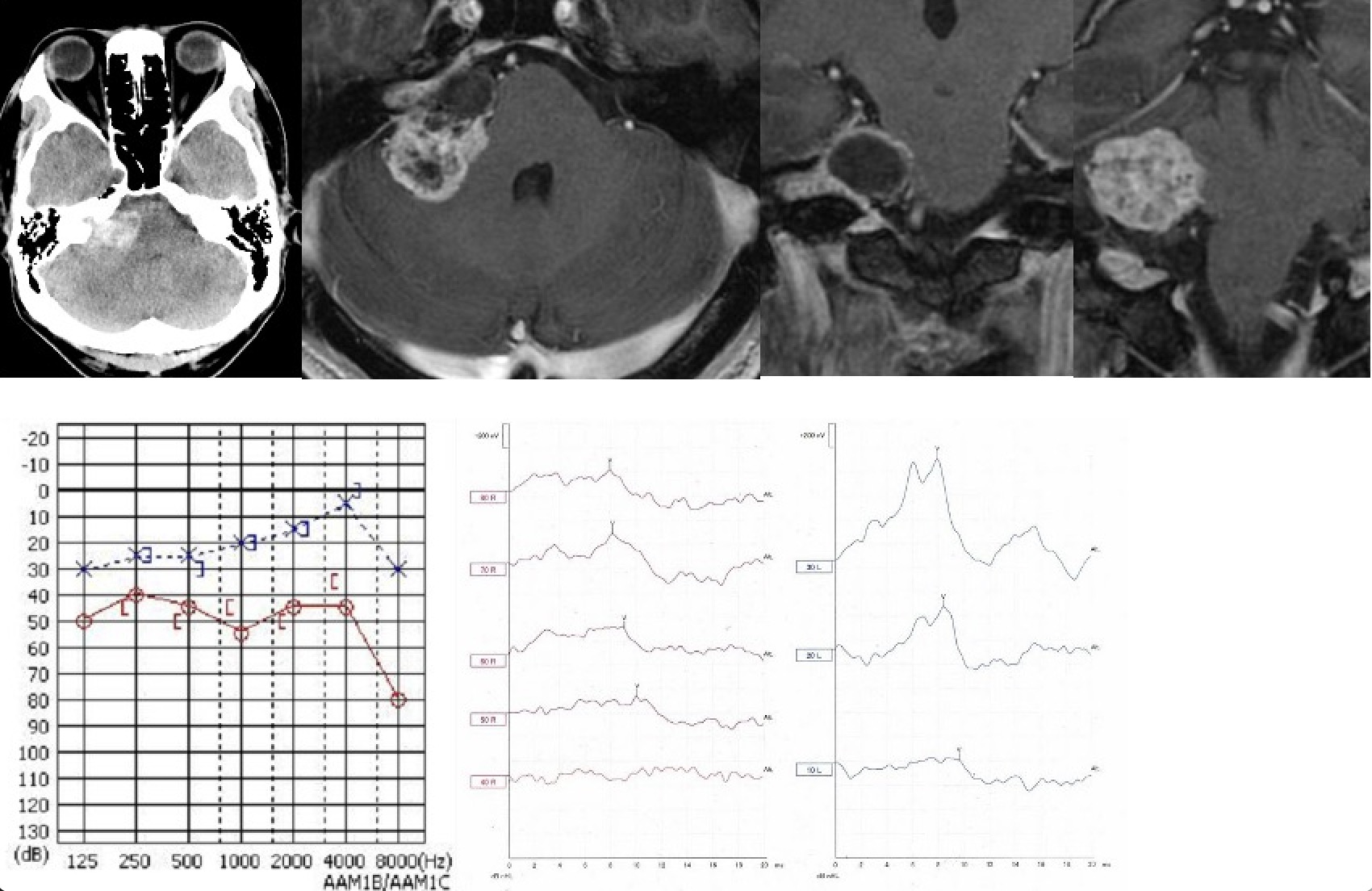 Koos grade 3の比較的大型のAT、嚢胞生は癒着している | 菊田医学部長のブログ